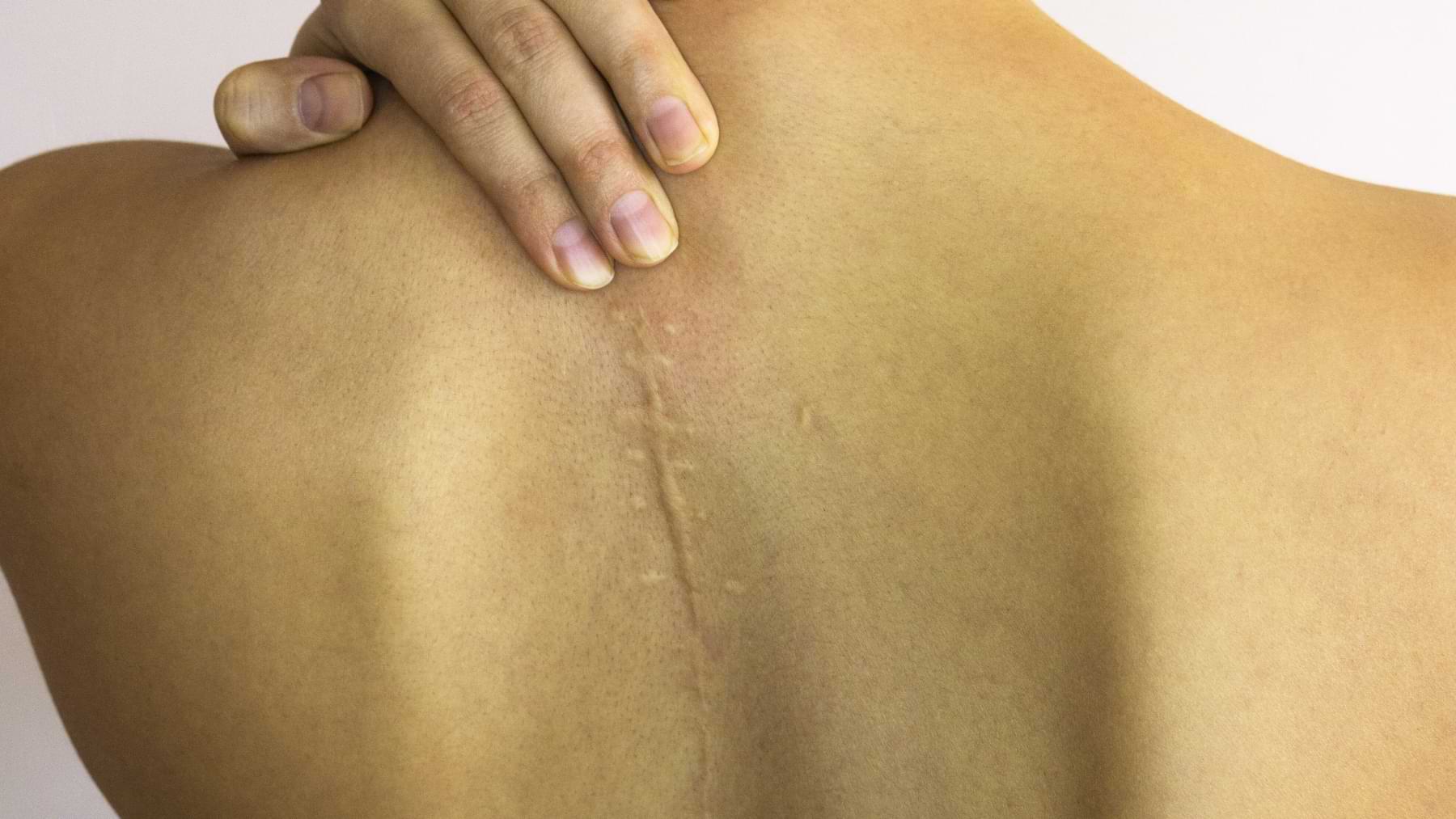 Understanding Scar Types: What to Expect – Nokori